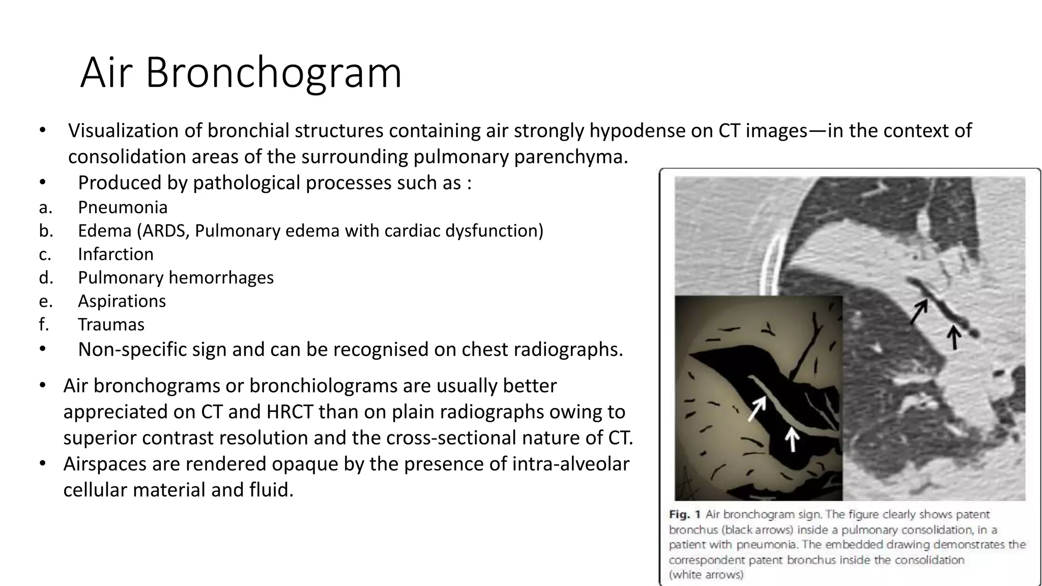 Thoracic radiological signs | PPTX | Lung and Respiratory Health ...