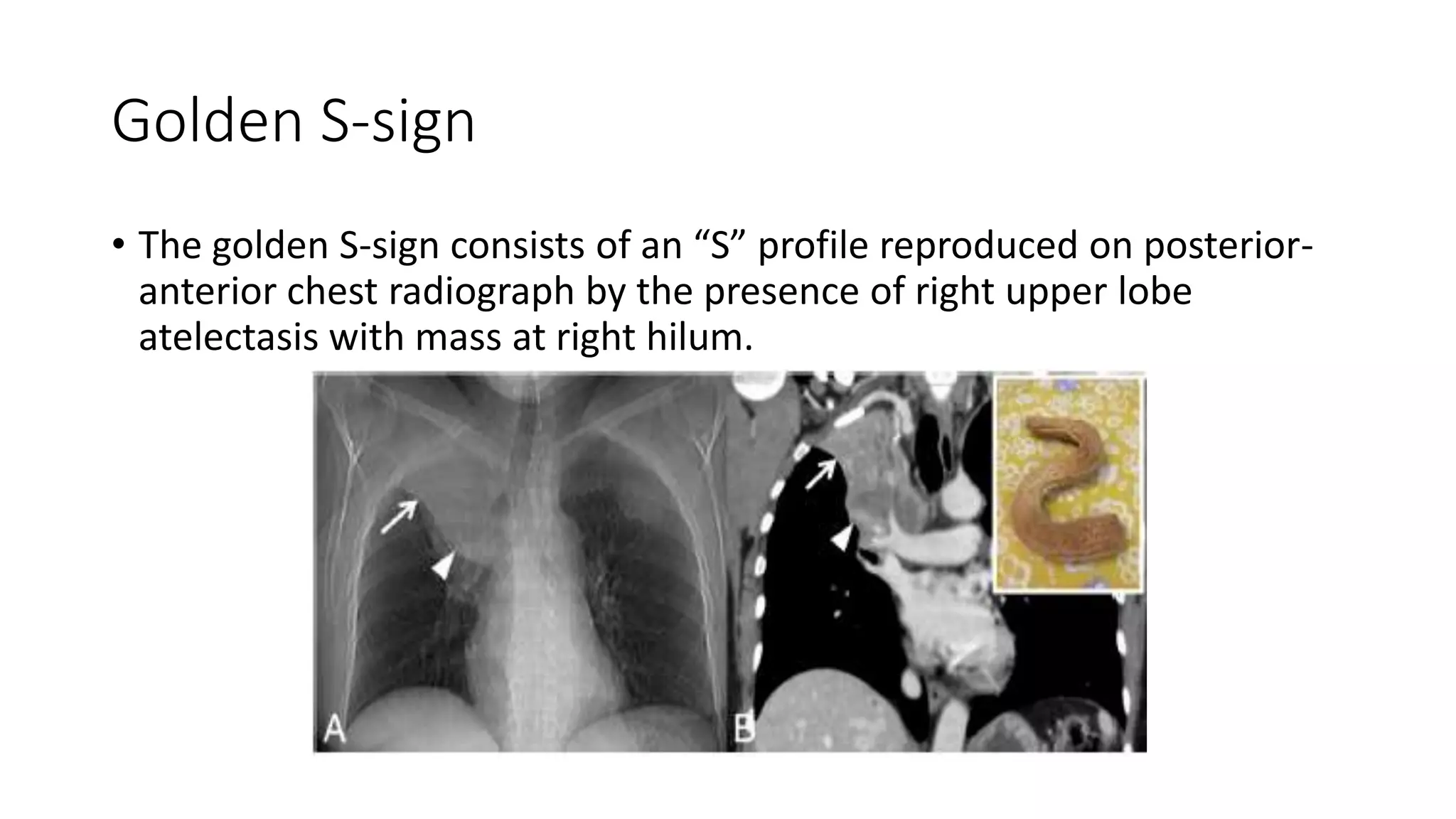 Thoracic radiological signs | PPT