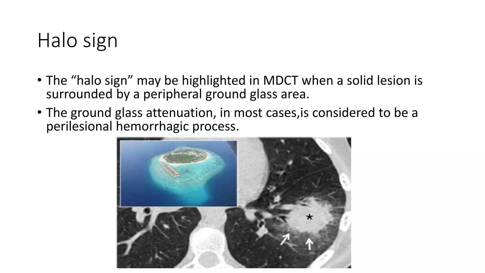 Thoracic radiological signs | PPT