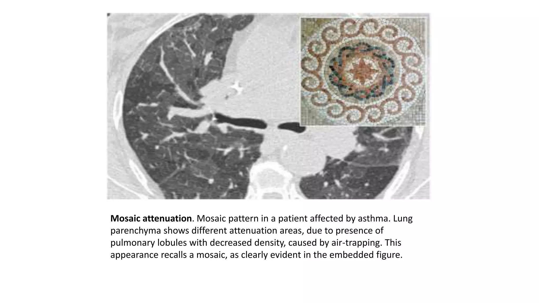 Thoracic radiological signs | PPTX