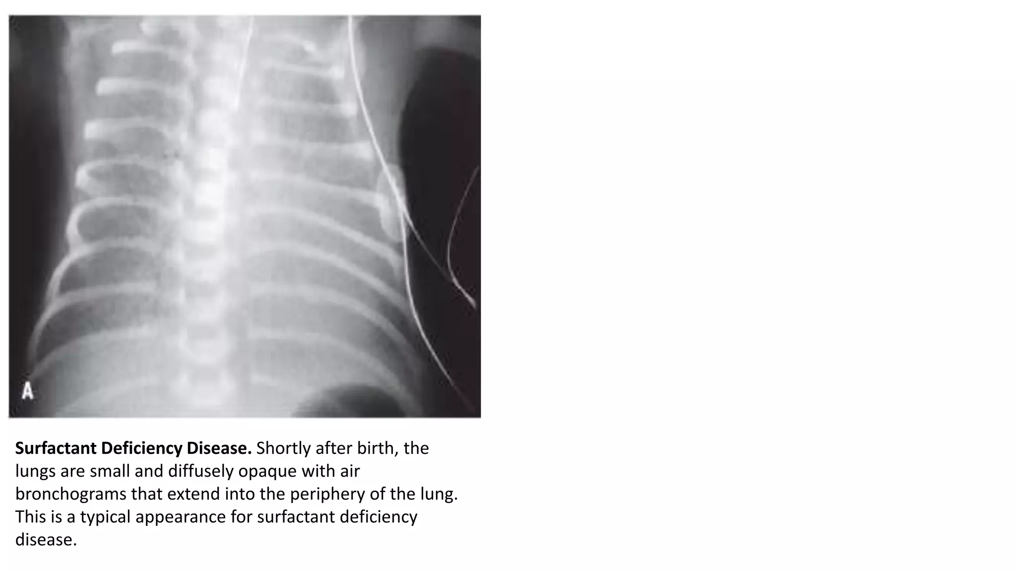 Thoracic radiological signs | PPT