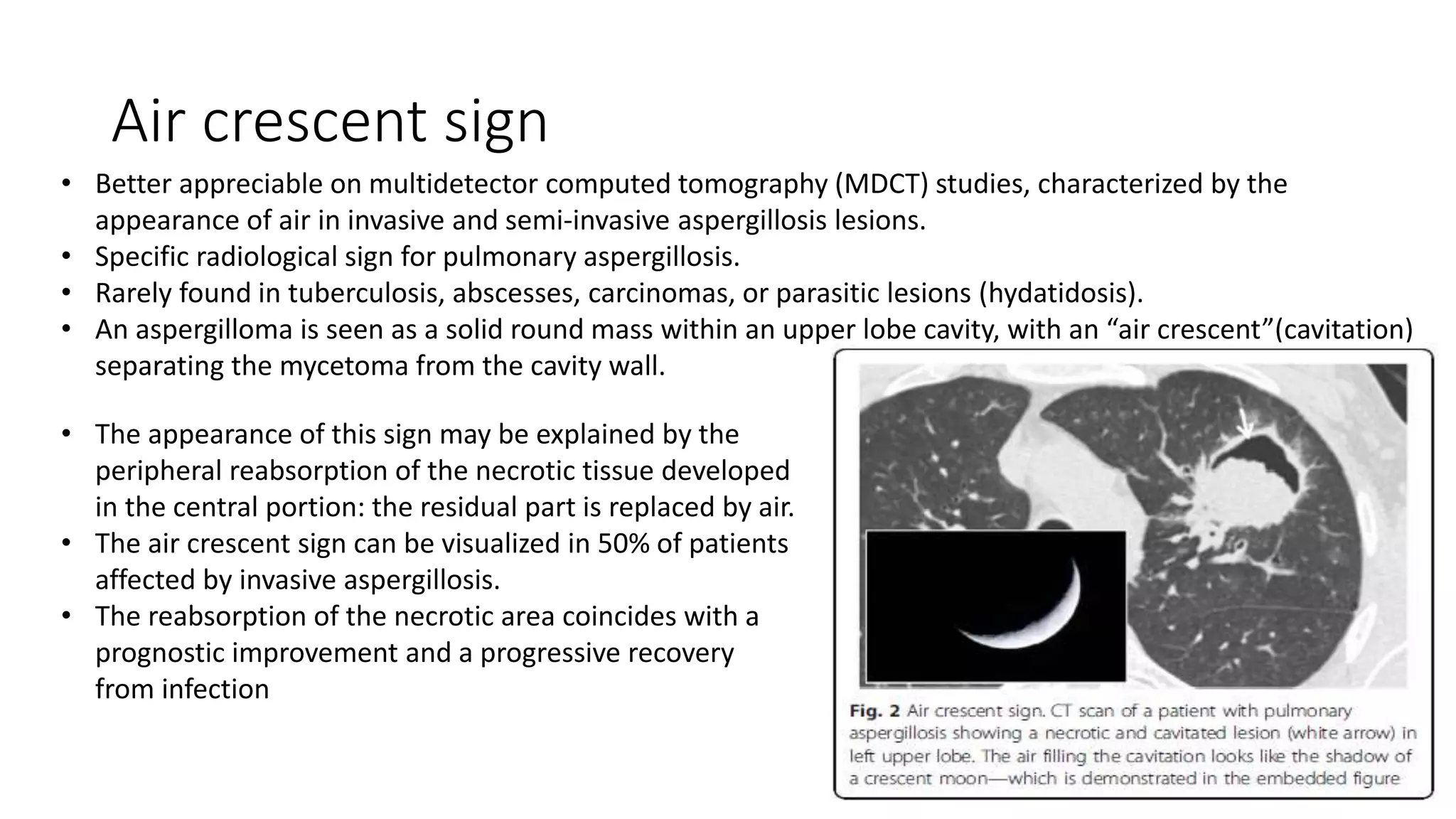Thoracic radiological signs | PPTX | Lung and Respiratory Health ...