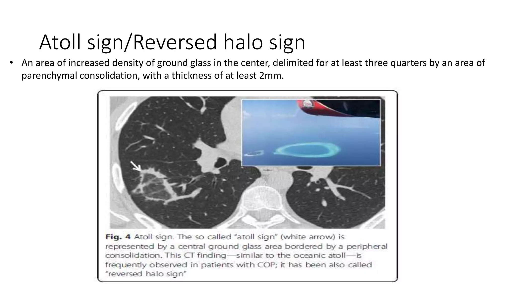Thoracic radiological signs | PPTX | Lung and Respiratory Health ...