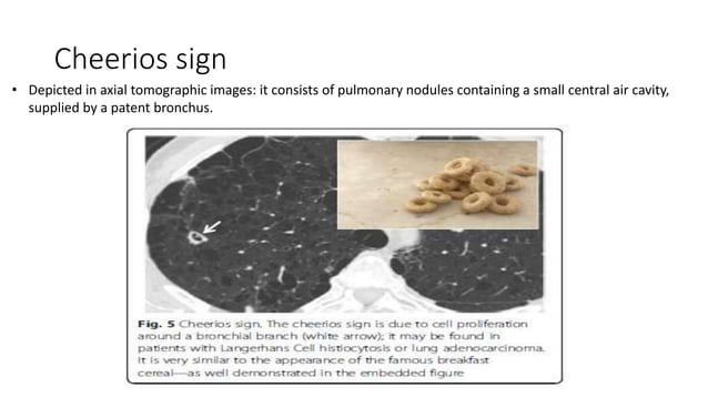 Thoracic radiological signs | PPT