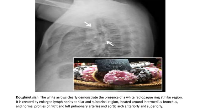 Thoracic radiological signs | PPT