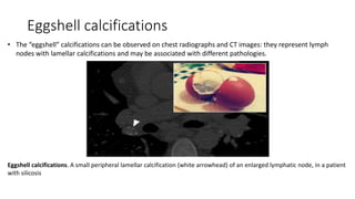 Thoracic radiological signs | PPTX