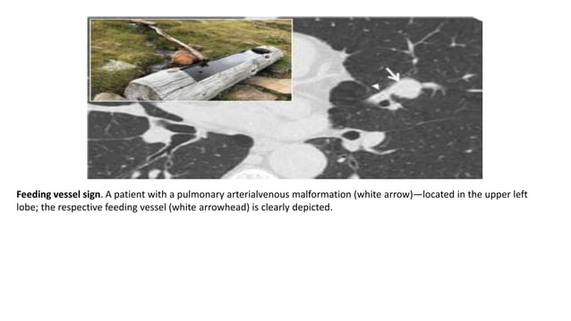 Thoracic radiological signs | PPT