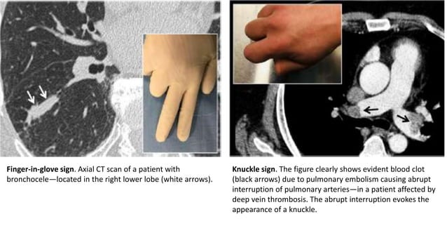 Thoracic radiological signs | PPT