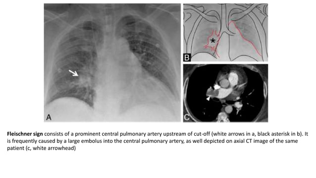 Thoracic radiological signs | PPT