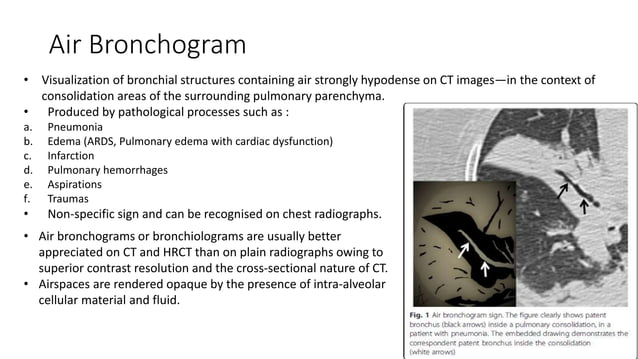 Thoracic radiological signs | PPT