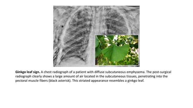 Thoracic radiological signs | PPT