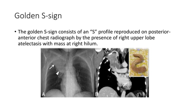 Thoracic radiological signs | PPT