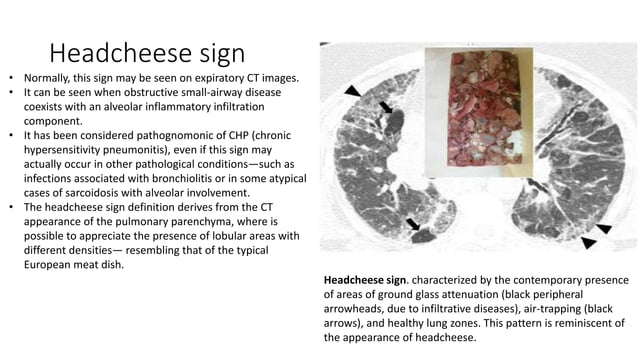Thoracic radiological signs | PPT
