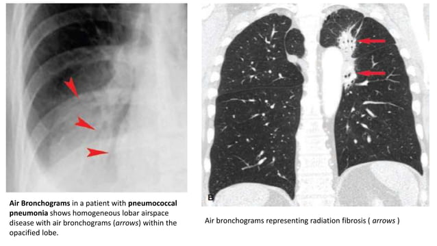 Thoracic radiological signs | PPT