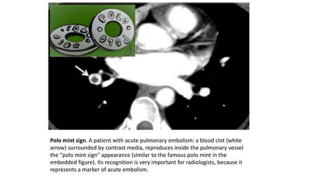 Thoracic radiological signs | PPT