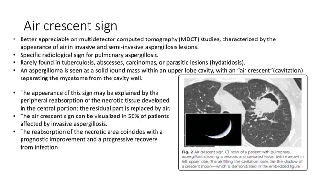Thoracic radiological signs | PPT
