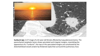 Thoracic radiological signs | PPTX