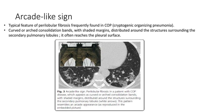 Thoracic radiological signs | PPT