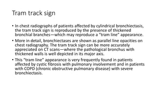 Thoracic radiological signs | PPTX