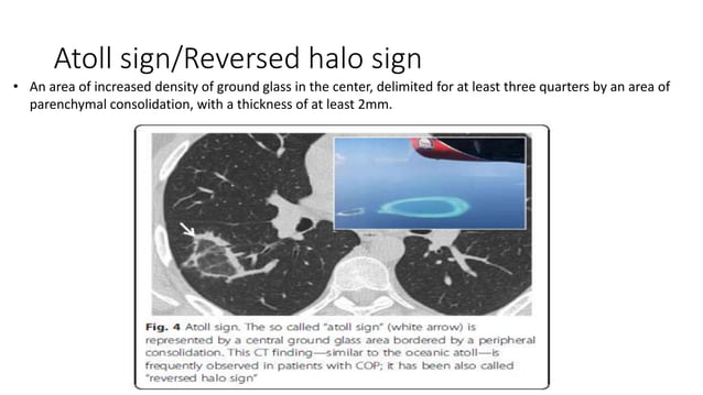 Thoracic radiological signs | PPT