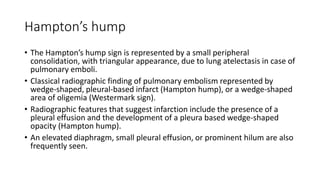 Thoracic radiological signs | PPTX