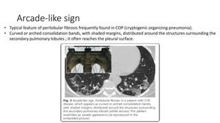 Thoracic radiological signs | PPT