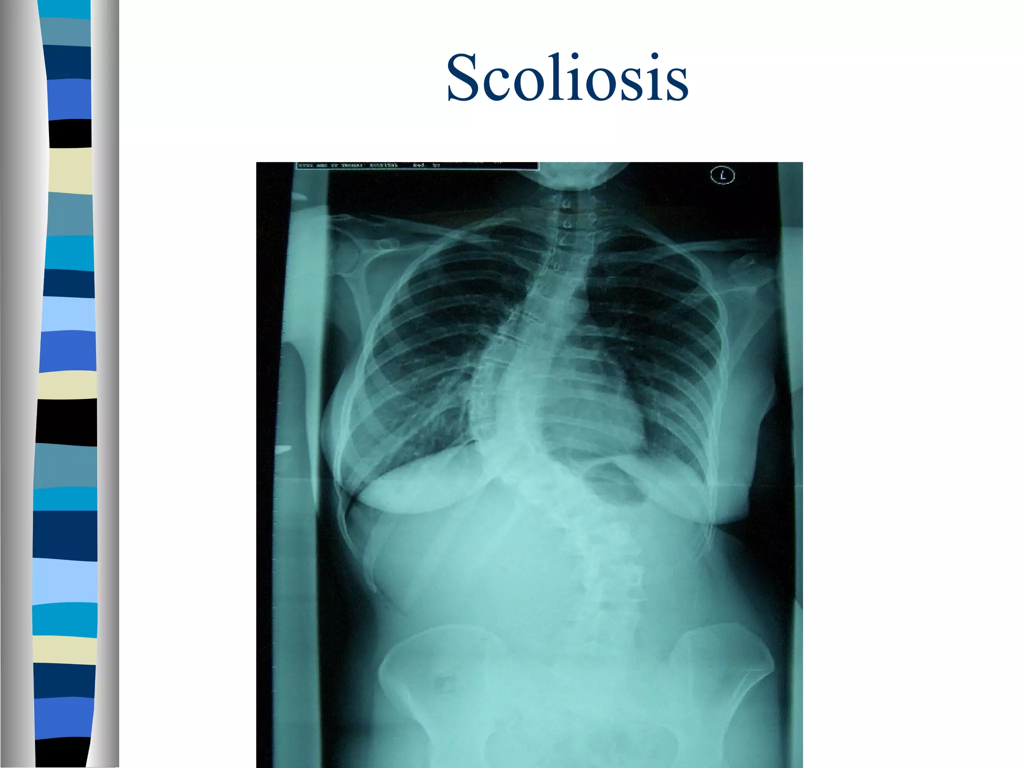 Thoracic spine | PPT