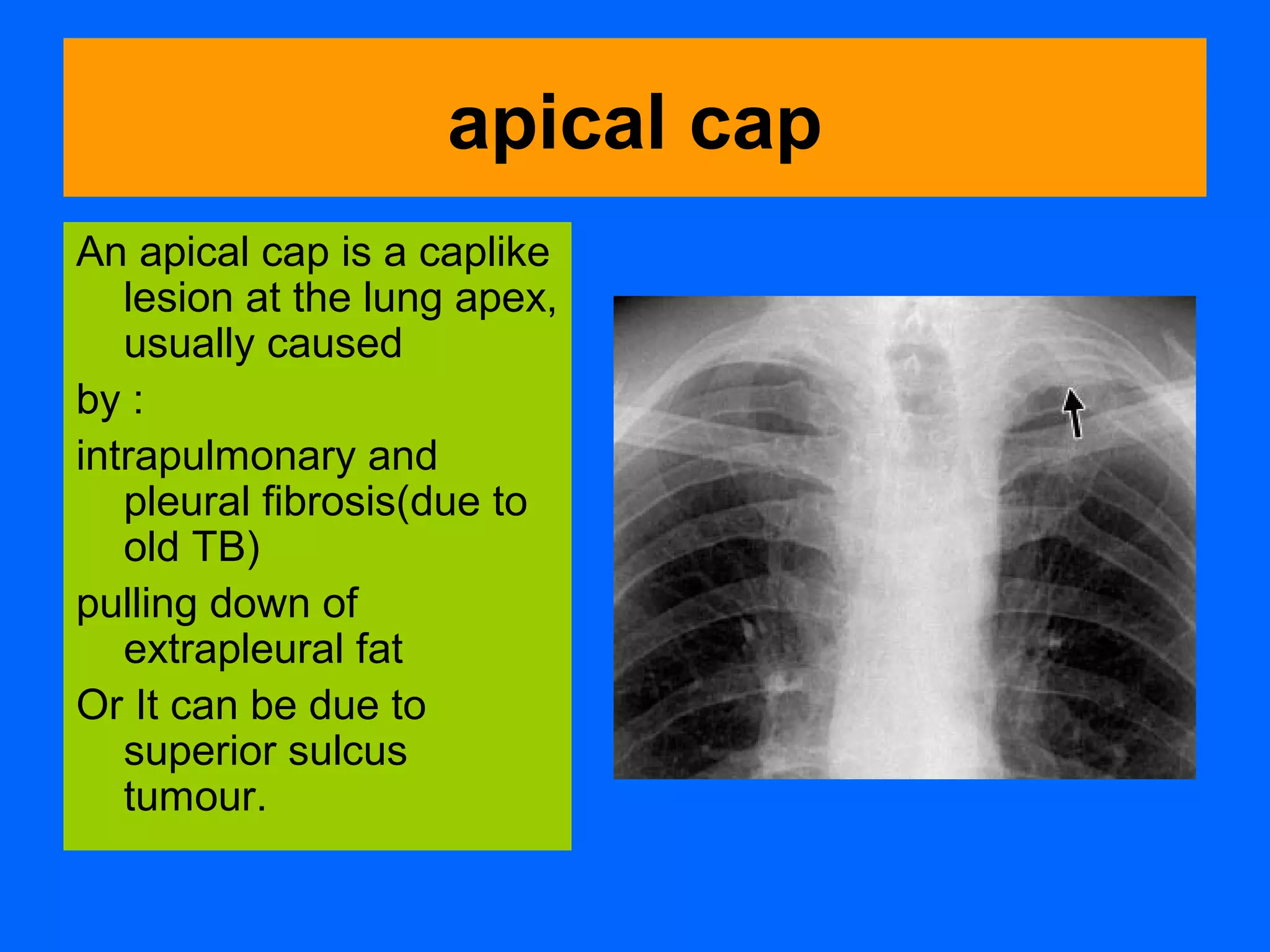 Thoracic imaging terminology | PPT