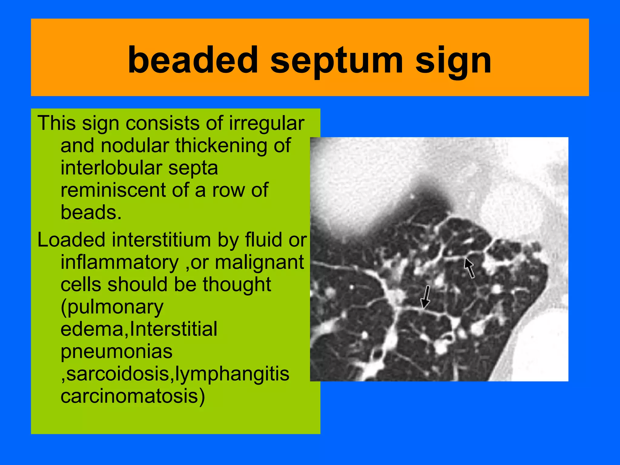 Thoracic imaging terminology | PPT