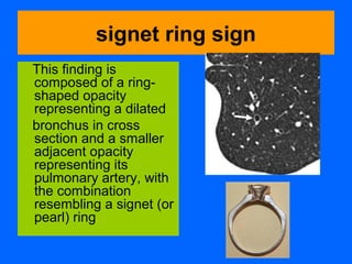 Thoracic imaging terminology | PPT