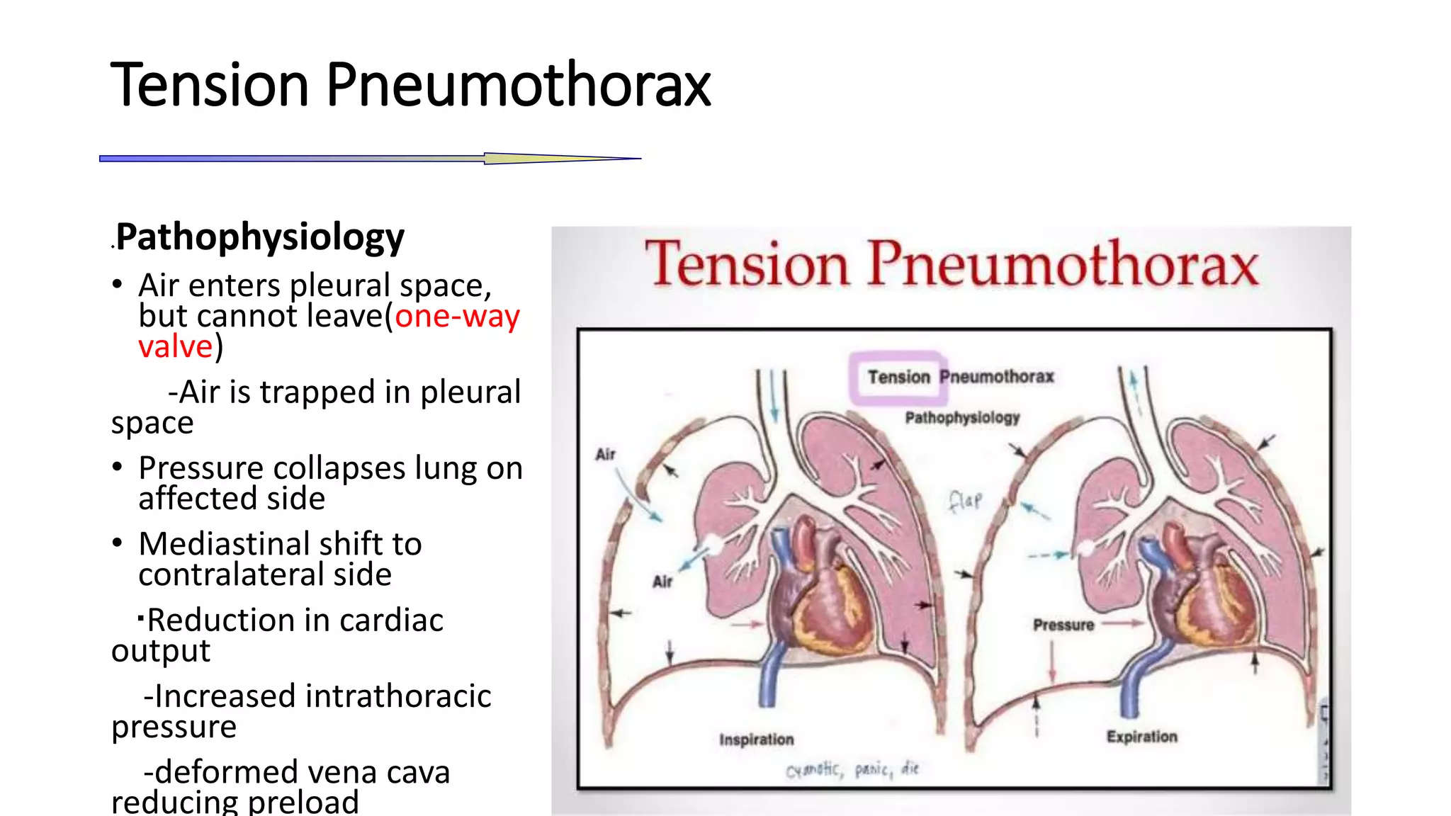 Thoracic trauma | PPTX