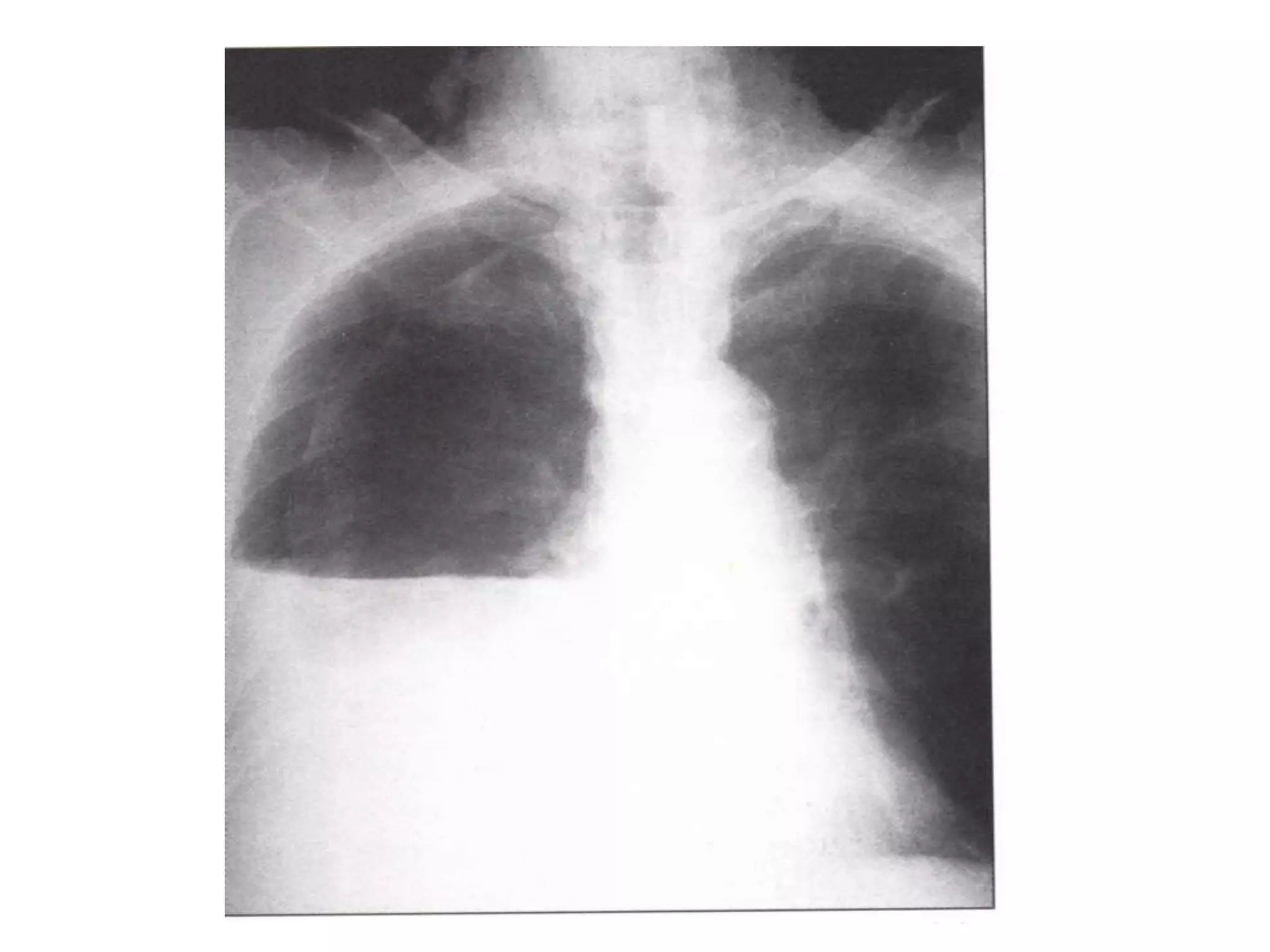 Thoracic trauma | PPTX
