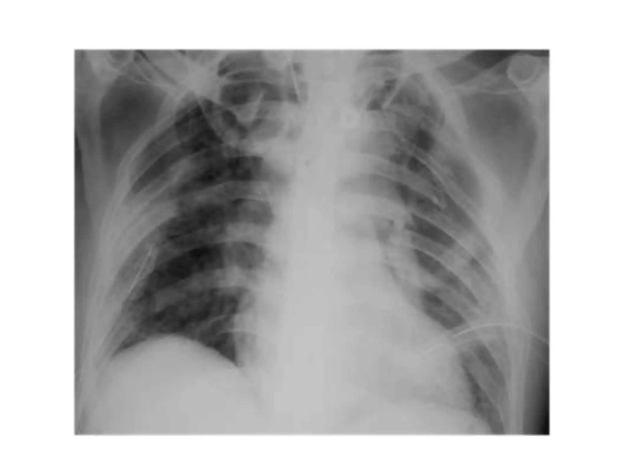 Thoracic trauma | PPTX