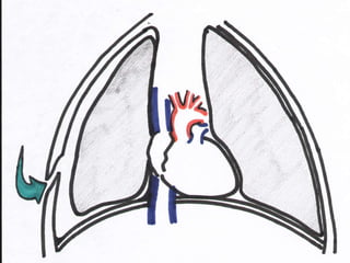 Thoracic trauma | PPTX