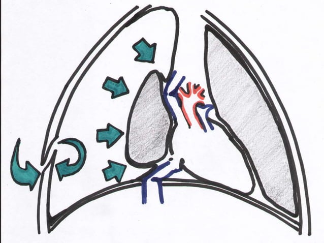 Thoracic trauma | PPT