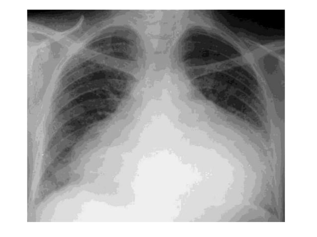Thoracic trauma | PPT