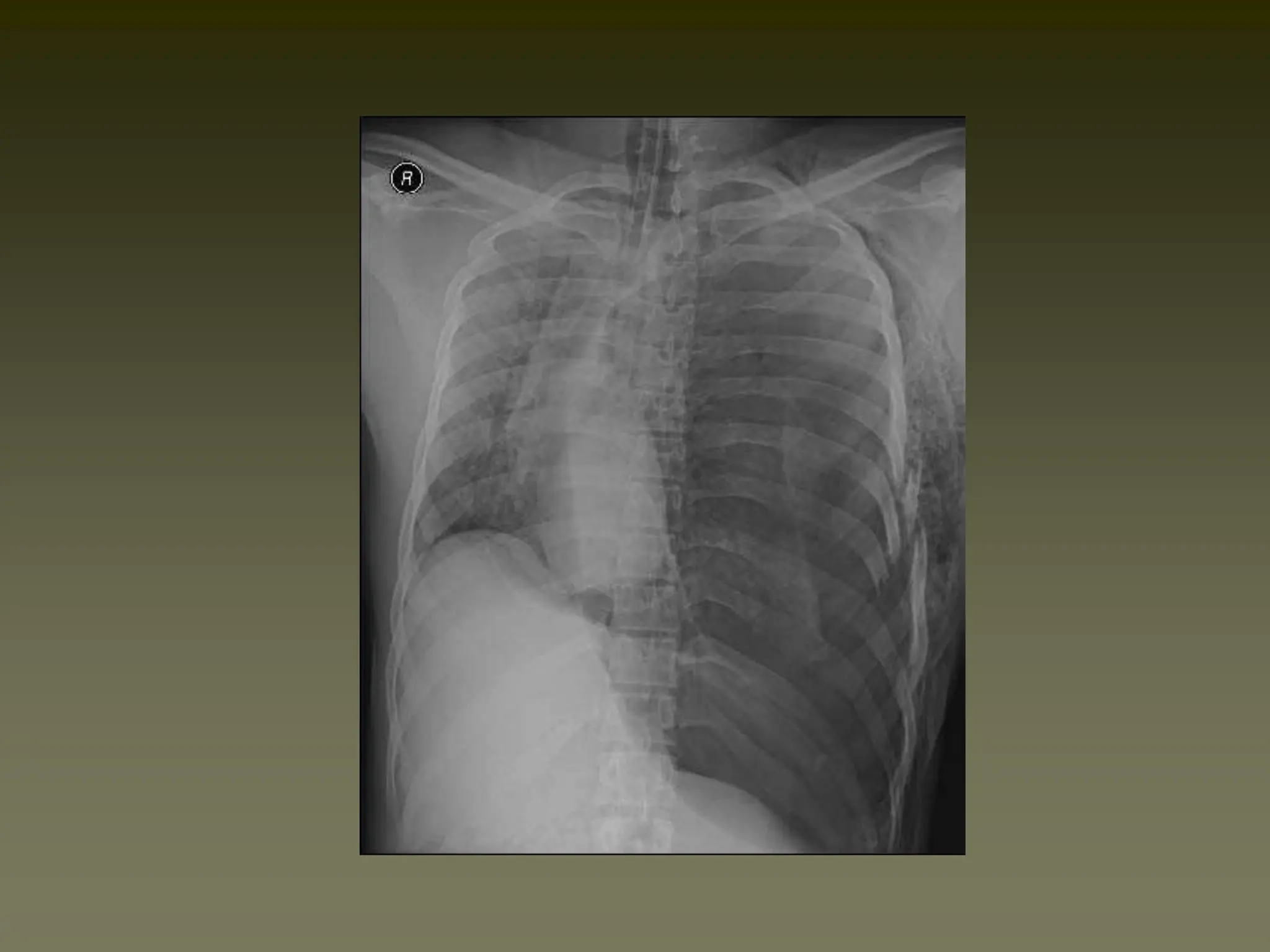 thoracic trauma all types of management.ppt