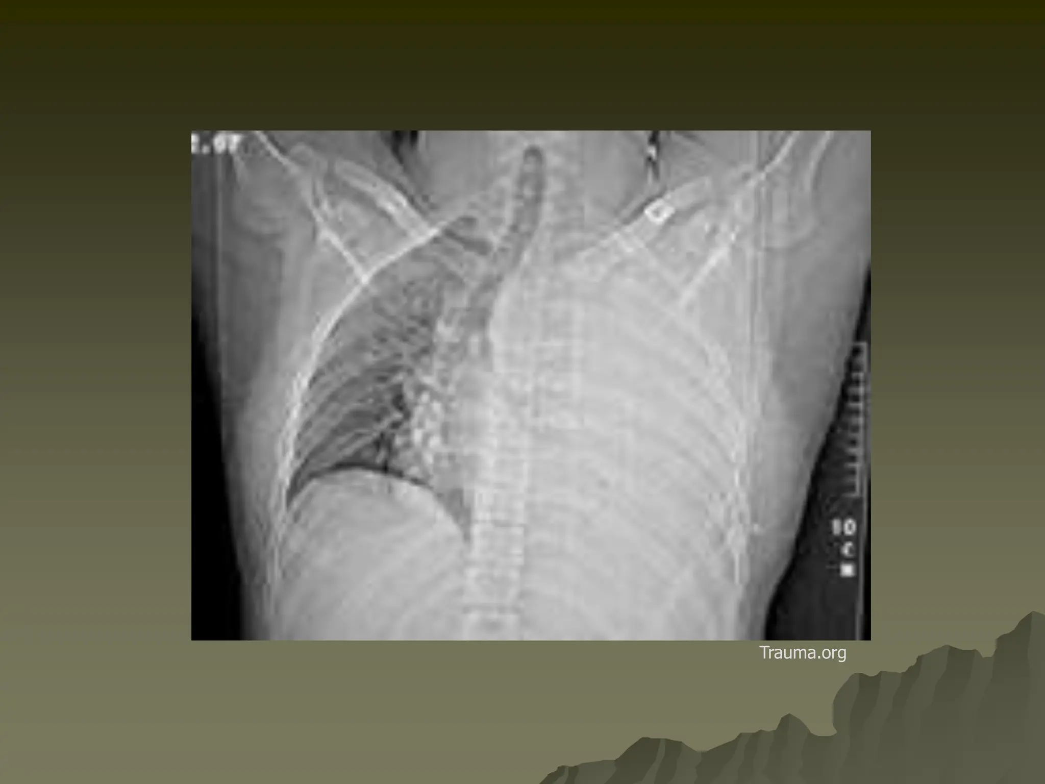 thoracic trauma all types of management.ppt