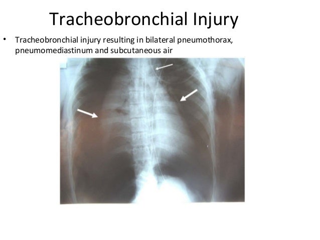 Thoracic Trauma