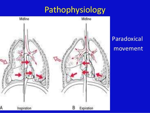 Thoracic trauma and pain management