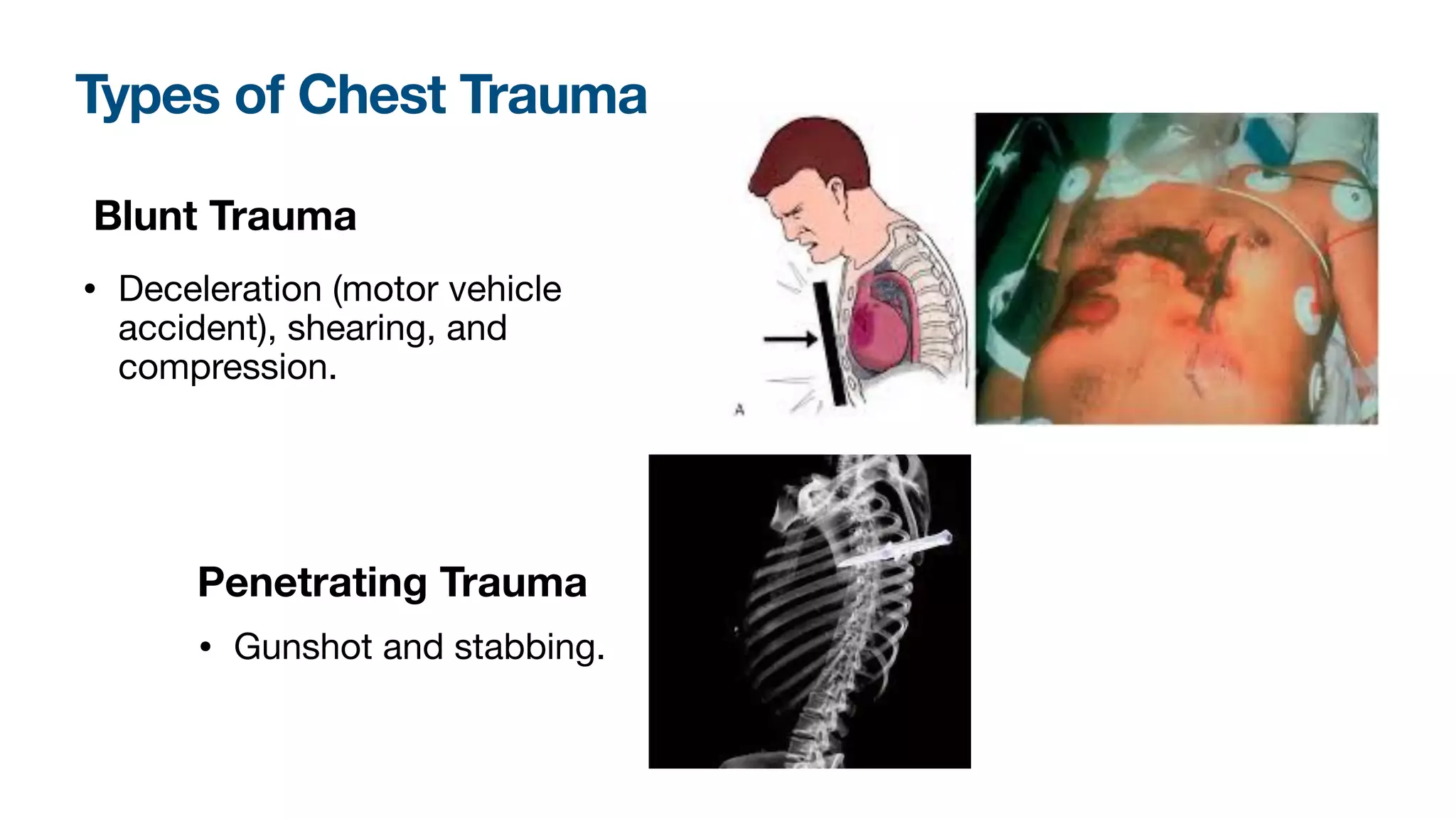 Thoracic Trauma - Navy Laksmono.pdf