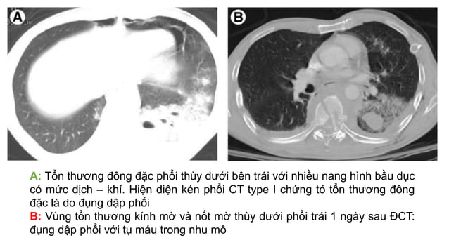 CĐHA chấn thương ngực - Thoracic trauma imaging | PPT