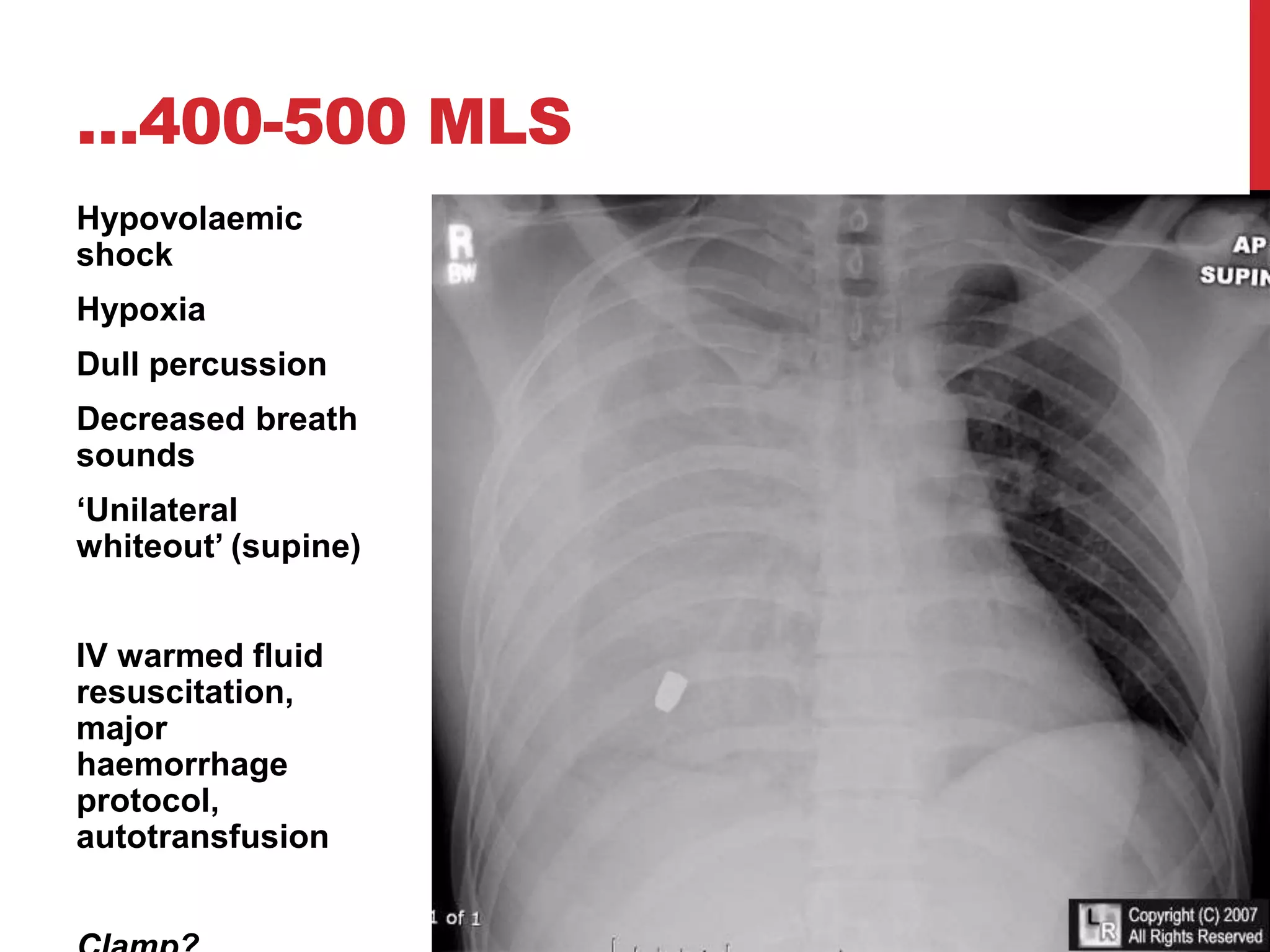 Thoracic trauma presentation | PPTX