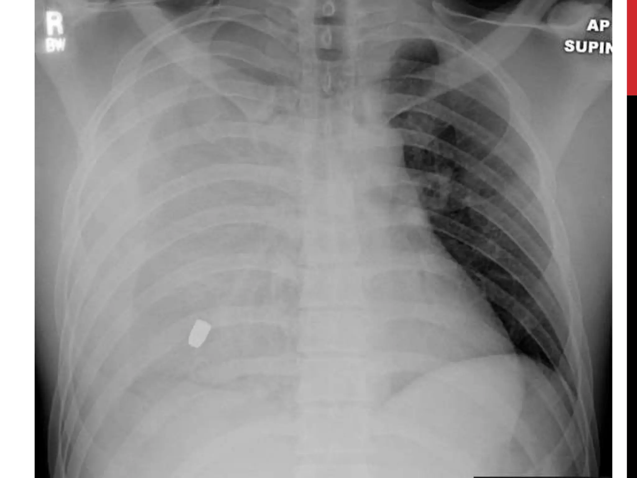 Thoracic trauma presentation | PPTX