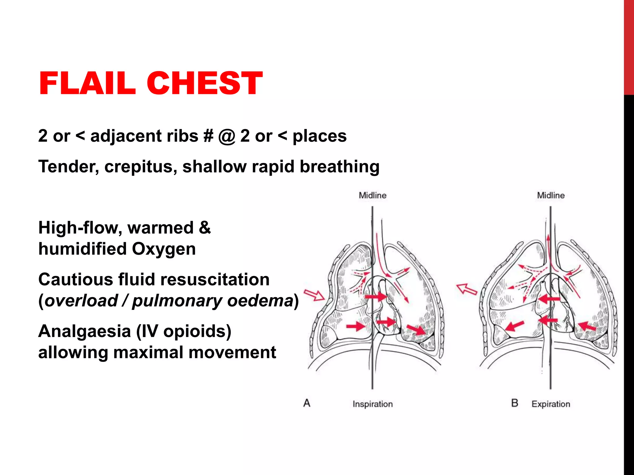 Thoracic trauma presentation | PPTX