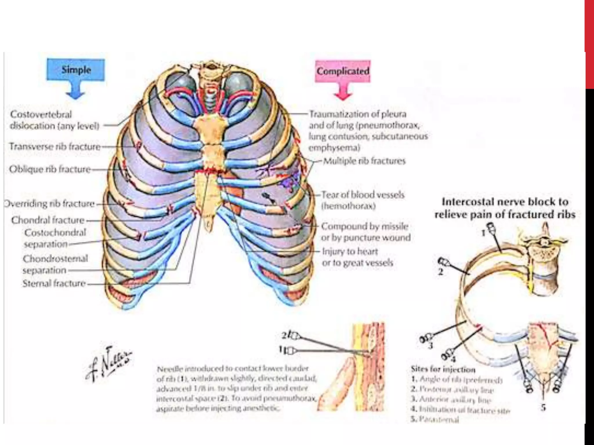 Thoracic trauma presentation | PPTX
