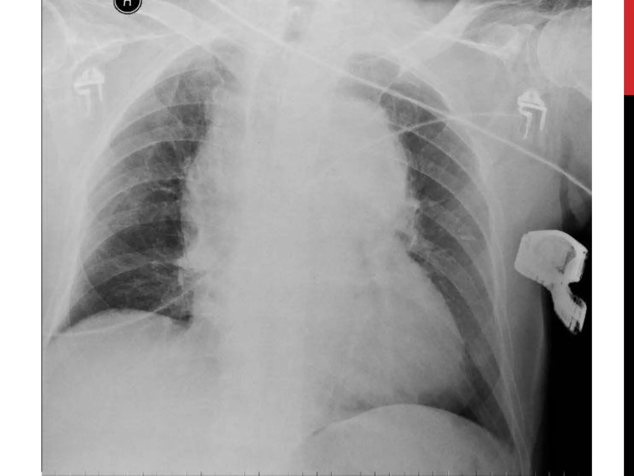 Thoracic trauma presentation | PPTX