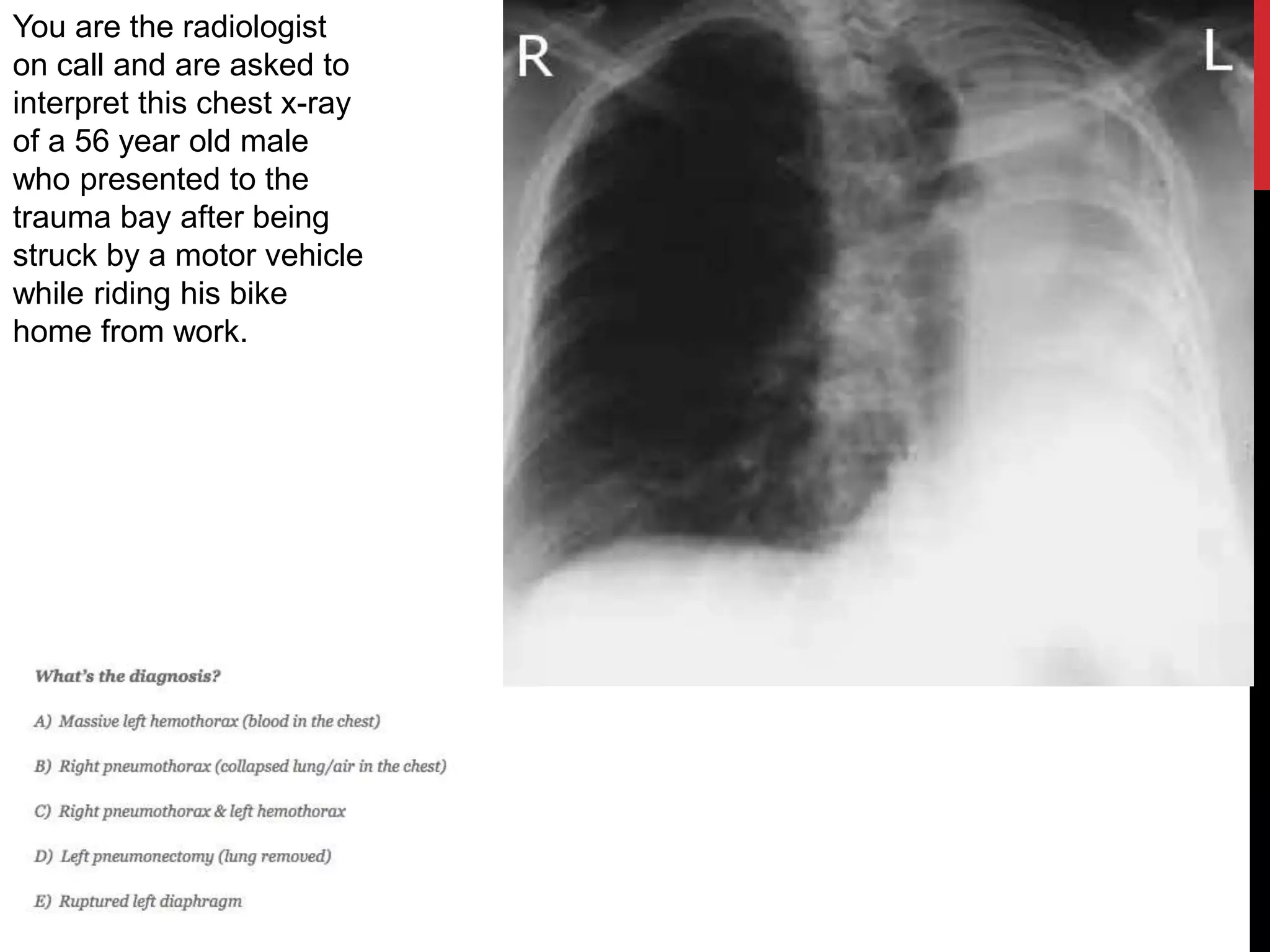 Thoracic trauma presentation | PPTX