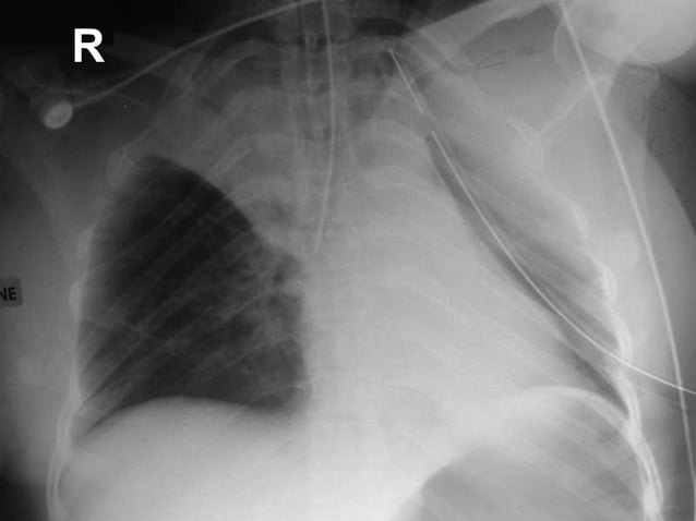 Thoracic trauma presentation | PPTX