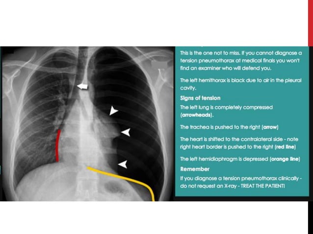 Thoracic trauma presentation | PPTX